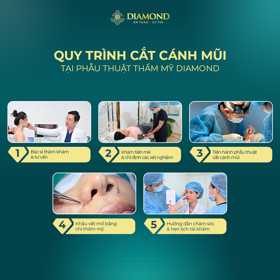 Cắt cánh mũi: quy trình, kết quả và lưu ý sau phẫu thuật